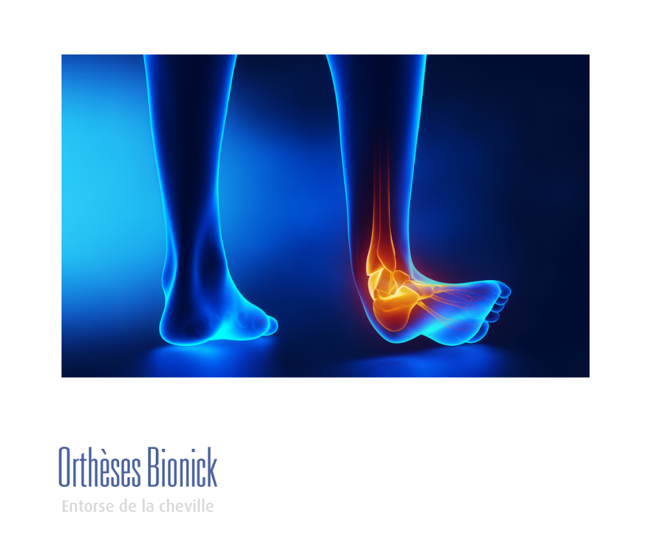 Entorse et fracture de la cheville - Orthèses Bionick