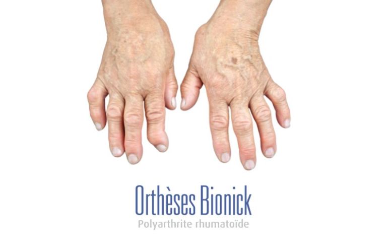 L’arthrite rhumatoïde et l’arthrose – Orthèses Bionick